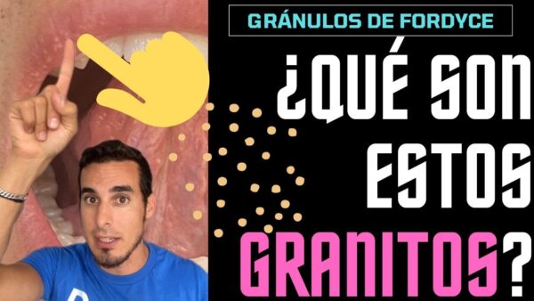 Descubre las causas y soluciones para los granitos en los labios ...