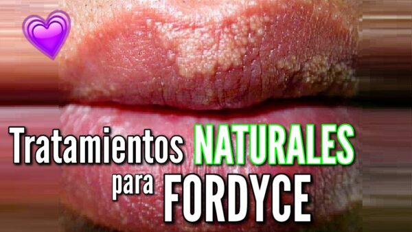 Descubre los mejores métodos naturales para curar los granos de Fordyce ...