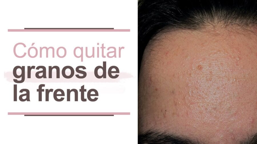 Consejos efectivos: Cómo quitar los granos de la frente y lucir una ...