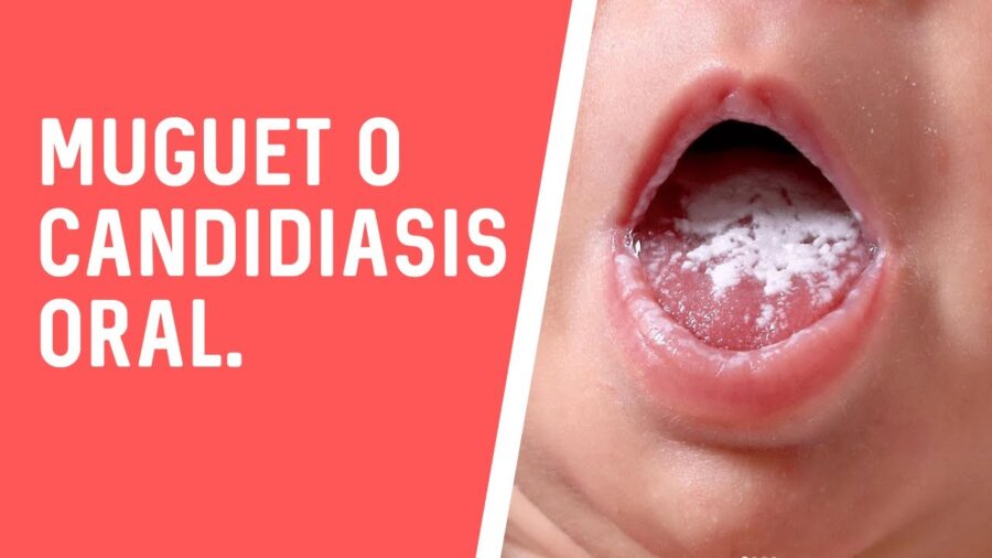 Descubre por qué sale el algodoncillo en bebés y cómo prevenirlo: todo ...