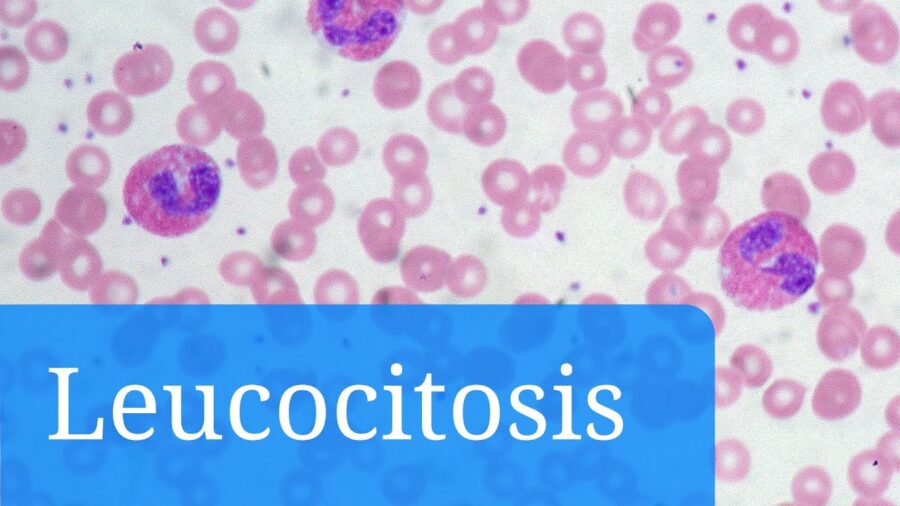 Descubre qué significa tener los leucocitos altos y cómo afectan tu ...